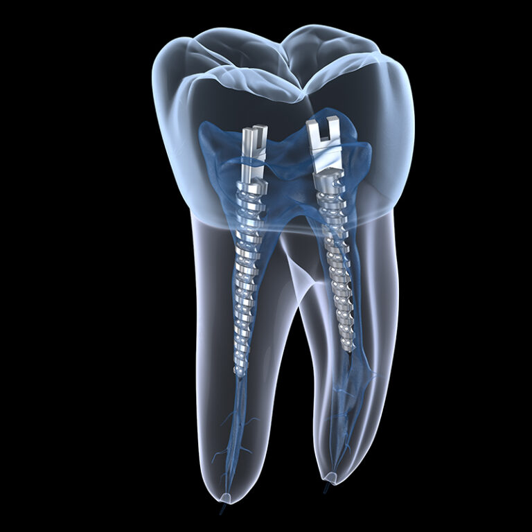 Root Canal Treatment (Endodontics) Philippines | Top-Rated Clinic