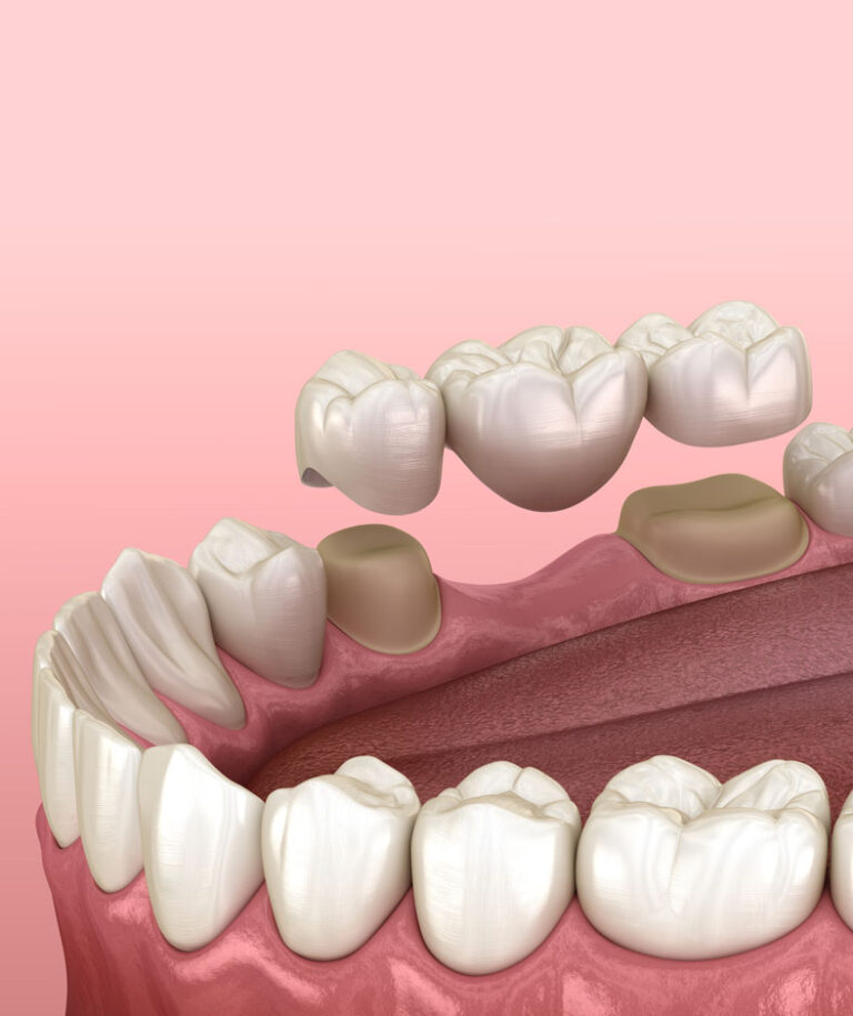 - Fixed Bridge Philippines - Smile More Dental-Manila