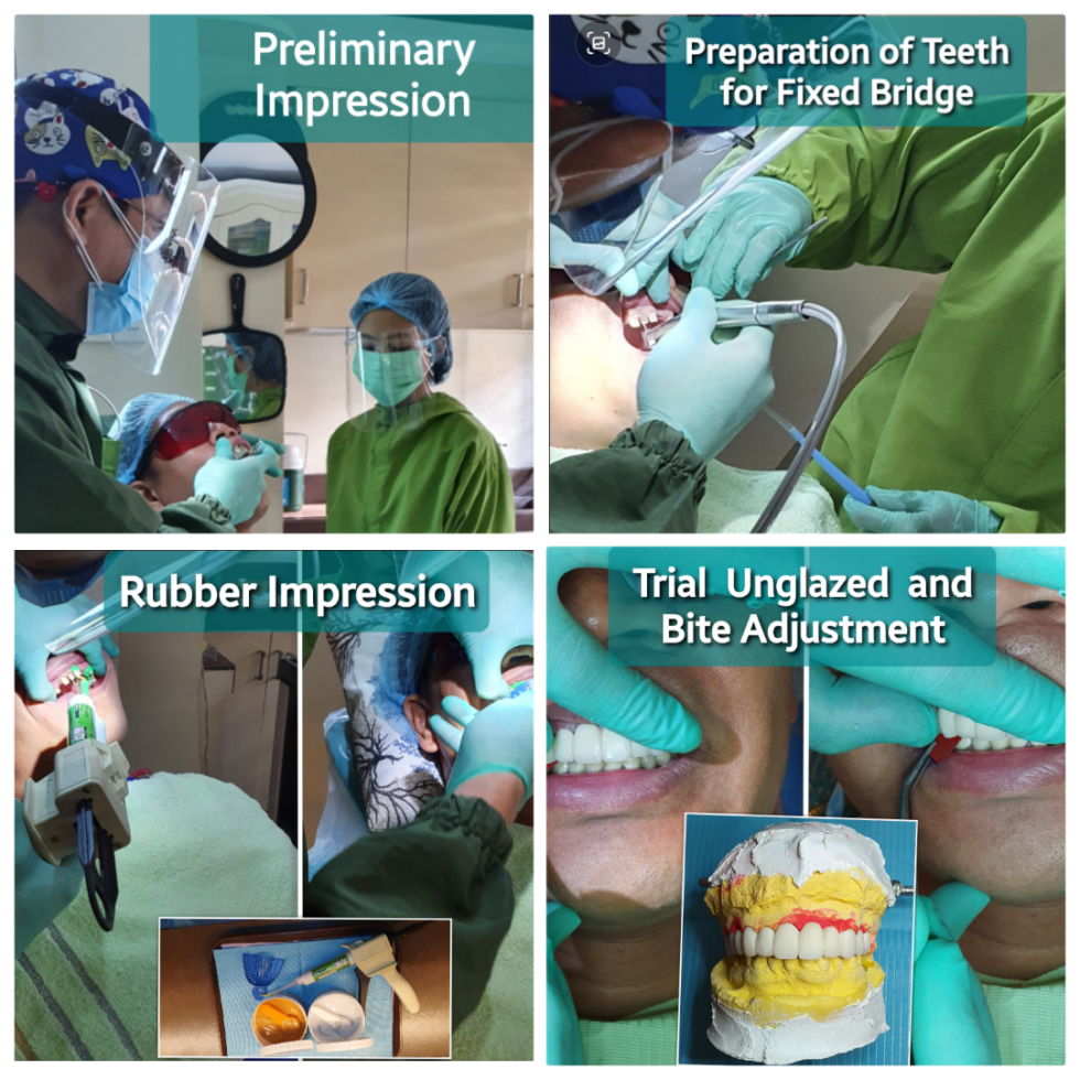 - Fixed Bridge Philippines - Smile More Dental-Manila