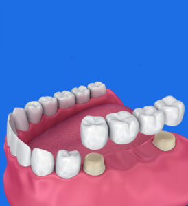 - Fixed Bridge Philippines - Smile More Dental-Manila