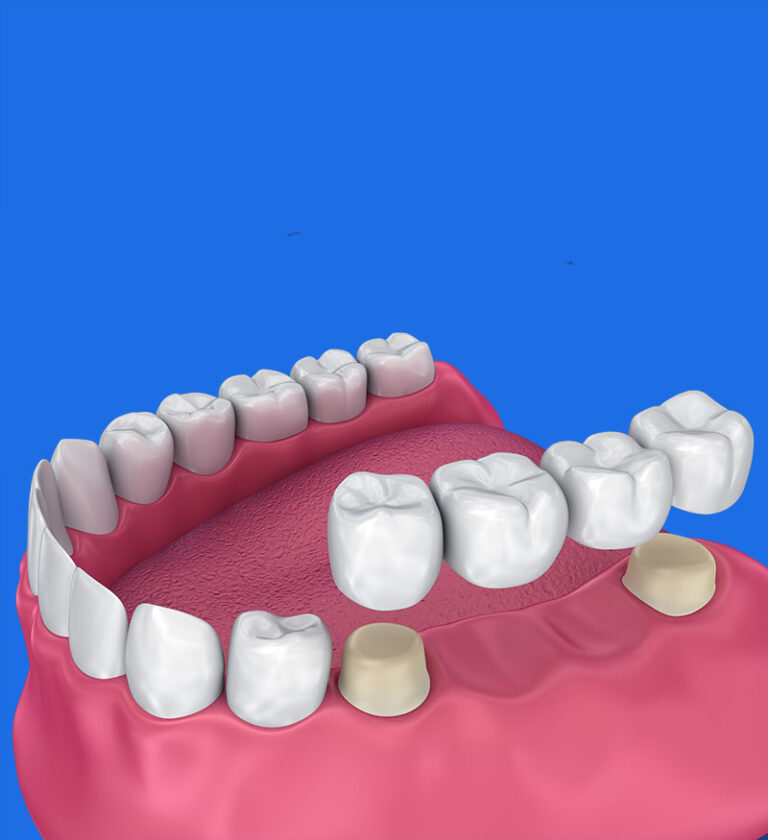 - Fixed Bridge Philippines - Smile More Dental-Manila