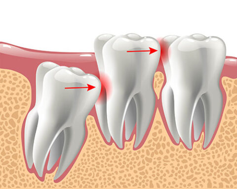 Impacted Third Molar Surgery | Wisdom Tooth Extraction