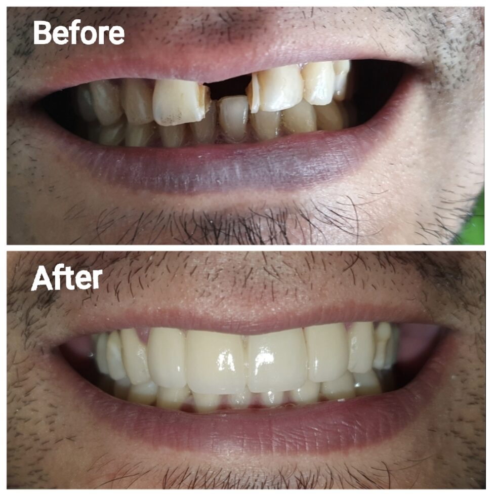 Fixed Bridge in Manila, Philippines - Solution For Missing Teeth