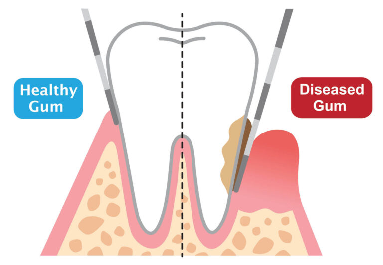 Gum (Periodontal) Disease Treatment | Deep Scaling | Philippines