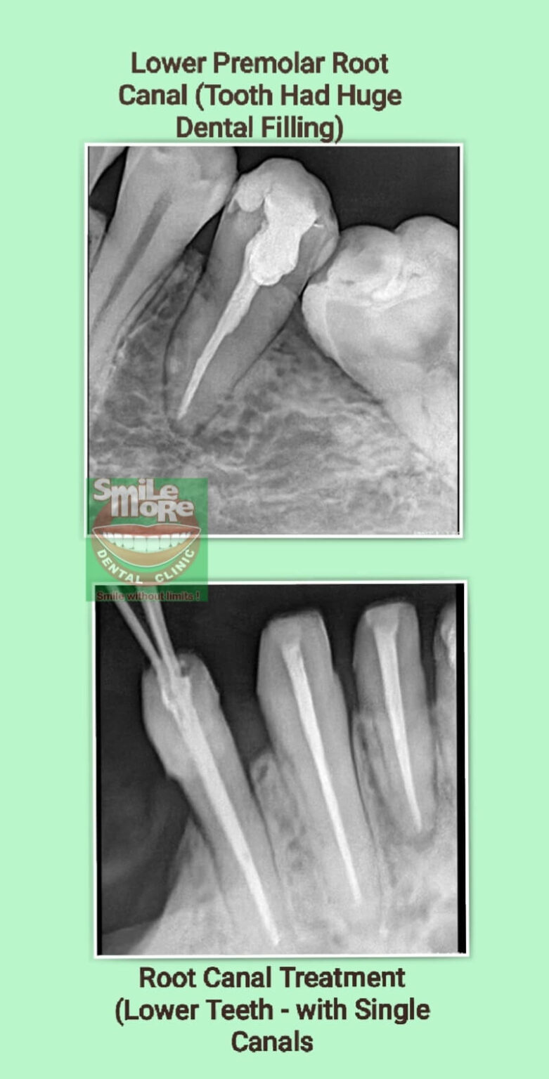 Philippines Root Canal Price: Essential Tips and Costs