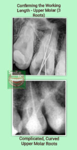 Philippines Root Canal Price: Essential Tips and Costs