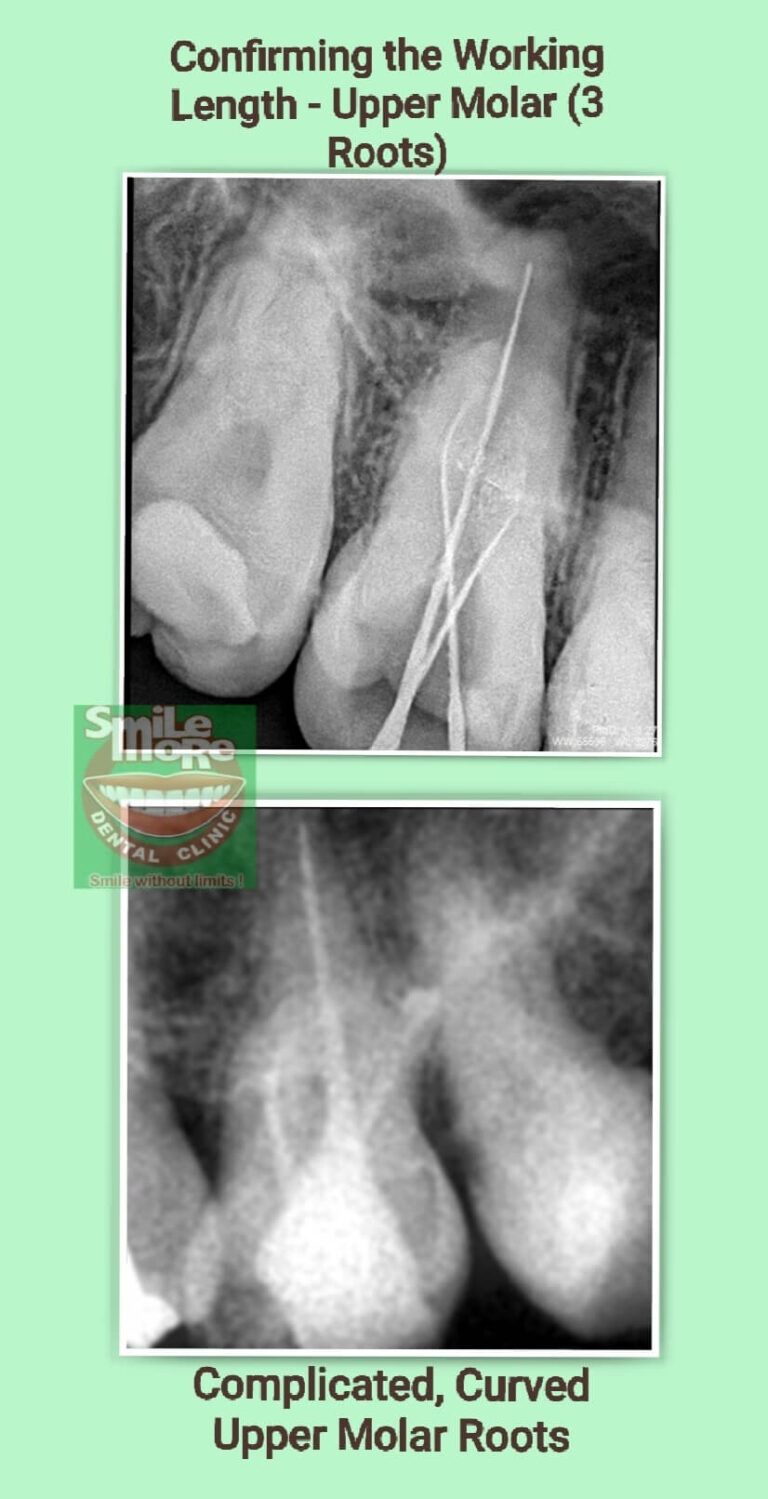 Philippines Root Canal Price: Essential Tips and Costs