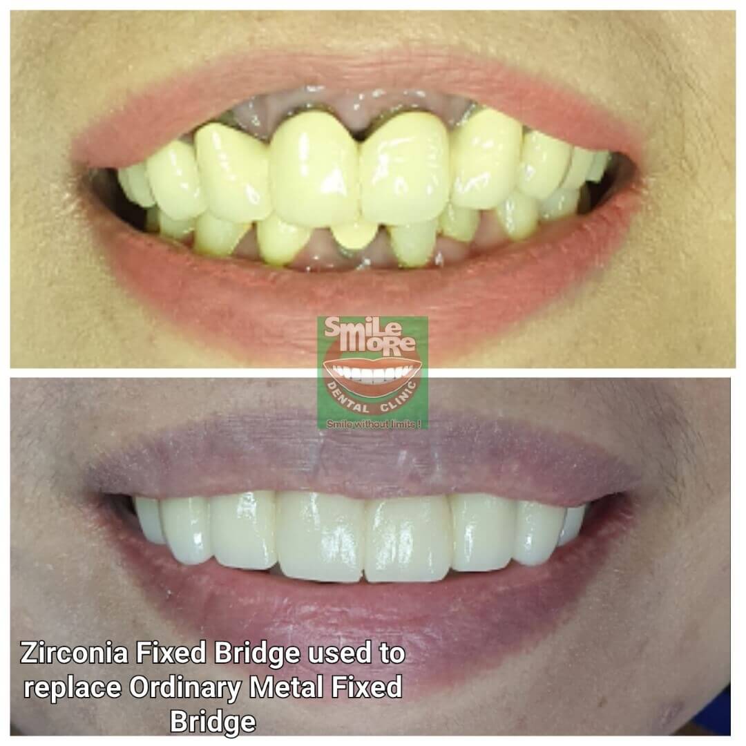 Dental Bridge Replacement Philippines | Manila's Leading Dentist