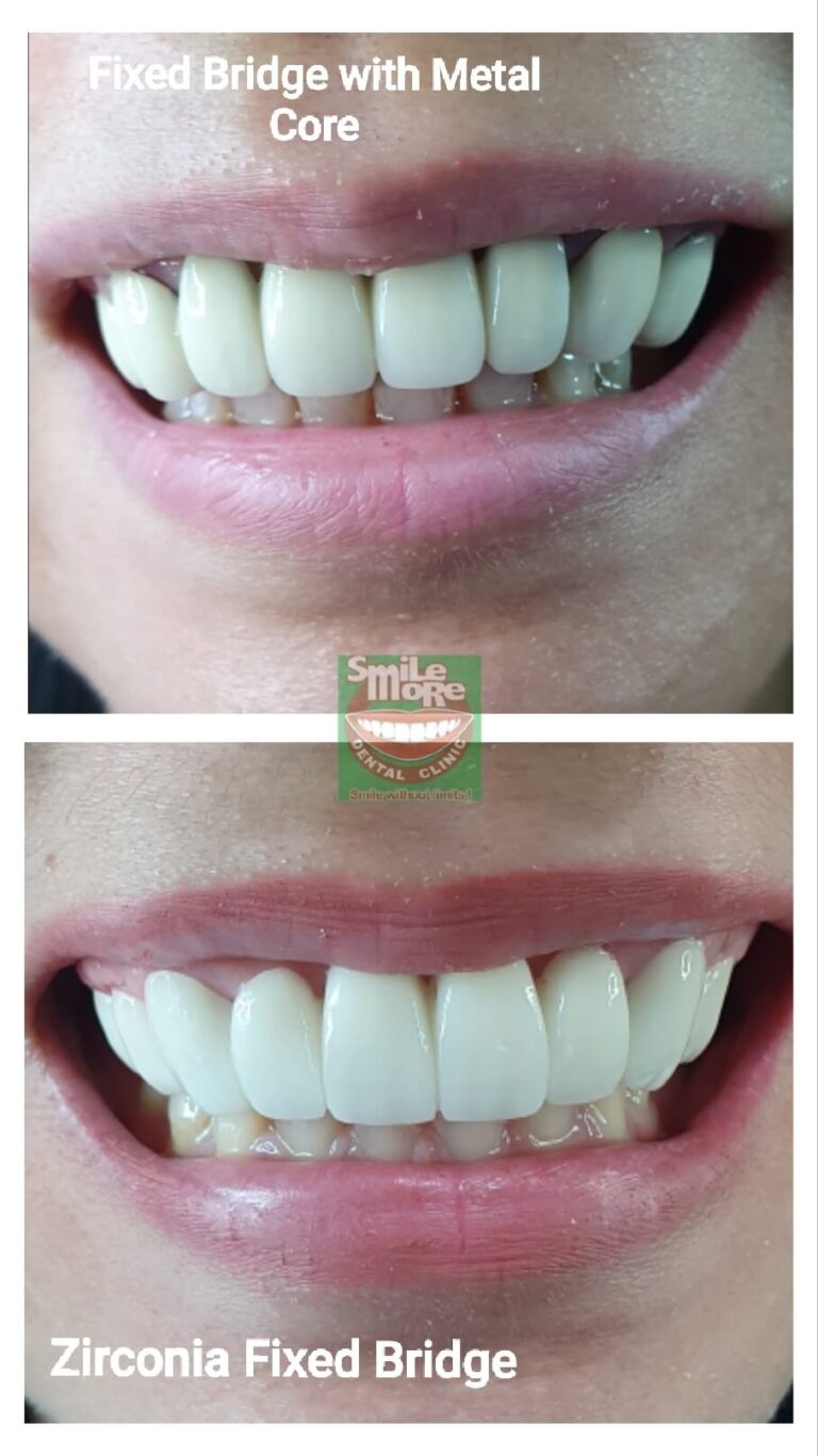 Fixed Bridge Philippines - Smile More Dental-Manila