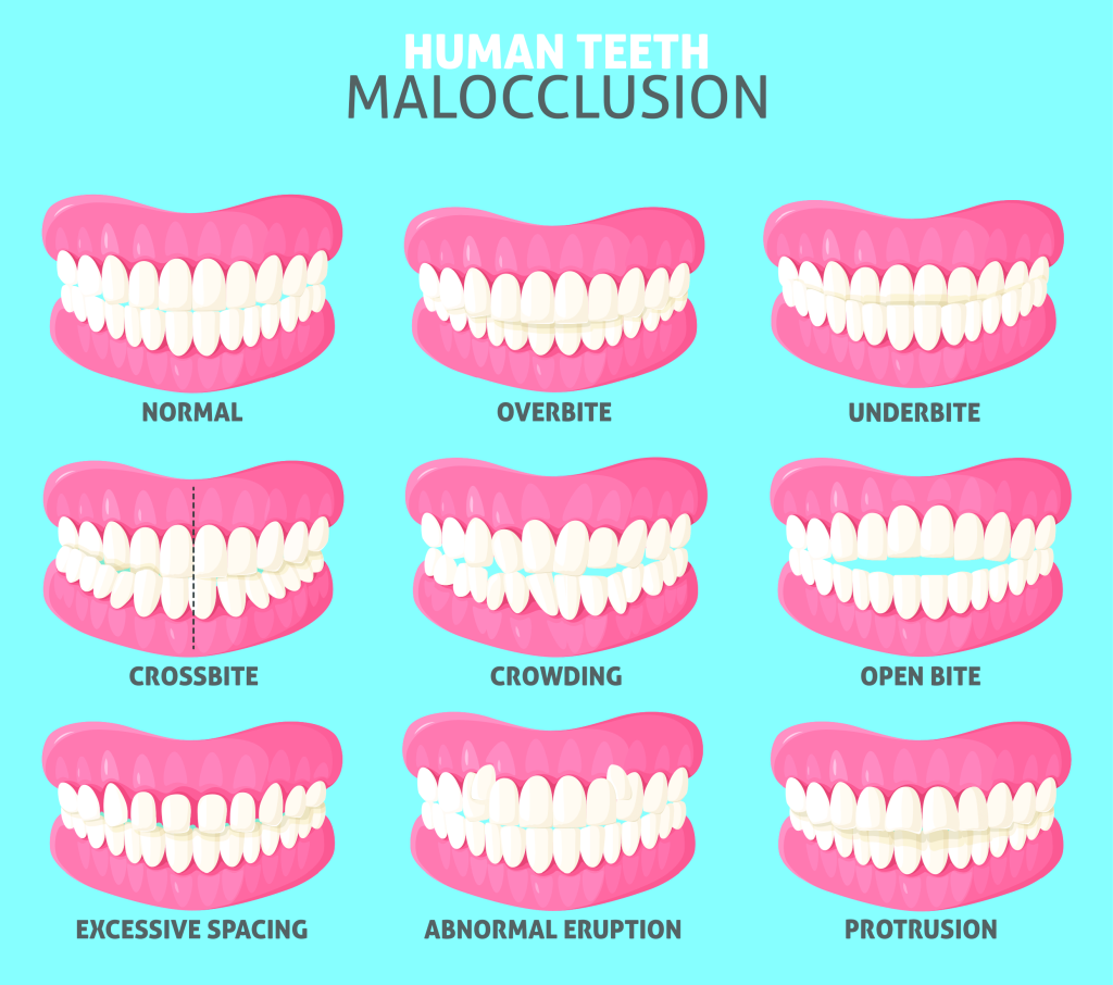 Dental Braces Cost Manila, Philippines -Options & What To Expect